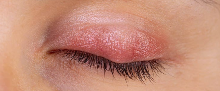 Quais doenças deixam o olho inchado? – Grupo HOSP