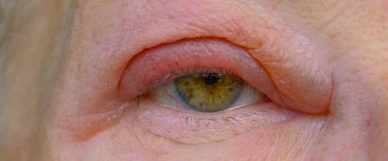 Quais doenças deixam o olho inchado? – Grupo HOSP